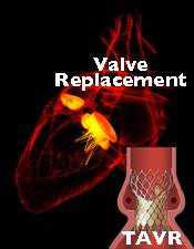 Heart Valve Replacement – Half a Century of Medical Innovation - McLeod ...