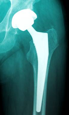 Cemented or Uncemented Hip Replacements: Which is your best choice ...
