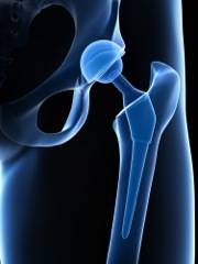 What’s The Scoop:Metal-on-Metal Hip Replacements? - McLeod Health