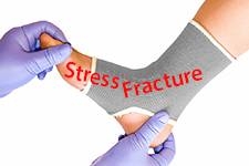 Stress Fractures in Feet Need Treatment and Care - McLeod Health