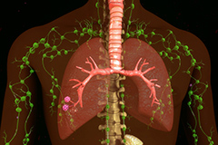 Cancer in the Lymph Glands: Risk Factors, Symptoms & Treatments ...