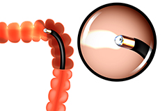 Treating Colon Cancer for a Longer Life - McLeod Health