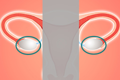 Oophorectomy: Removing Potentially Troublesome Ovaries - McLeod Health