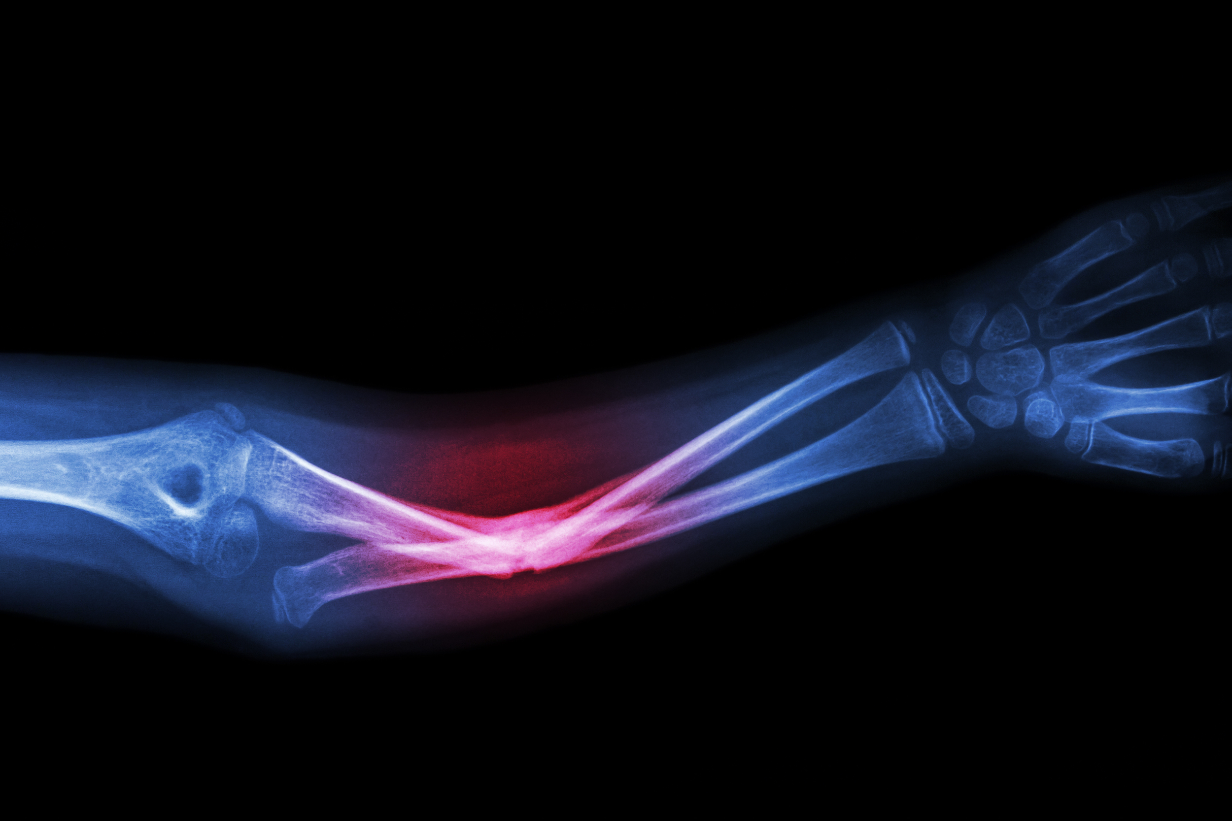 Malunion and Nonunion Fractures: Orthopedic Cold Trauma - McLeod Health